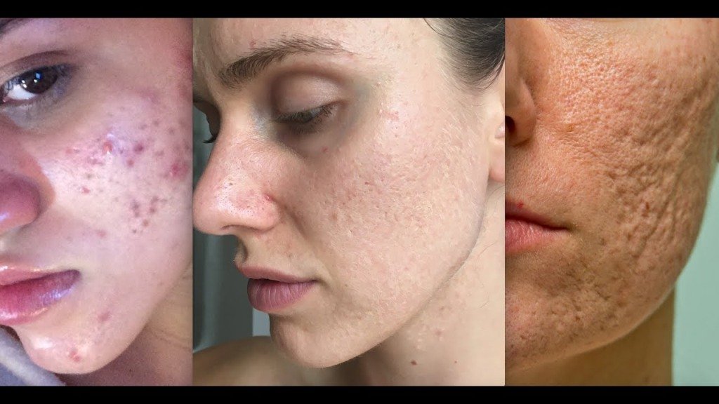 7 Best Acne Scar Treatments Recommended By Dermatologists Available Ideas 7 Best Acne Scar Treatments Recommended By Dermatologists Available Ideas