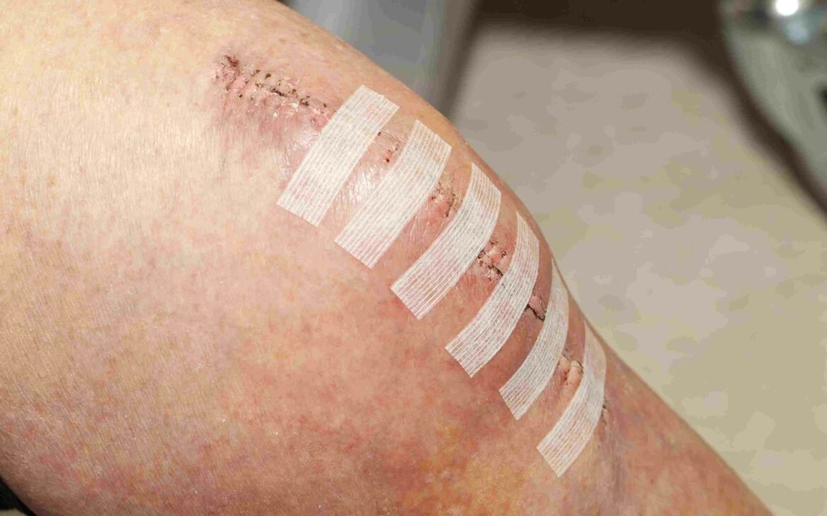 Post Surgery Wound Care: Wound Care Guide - Available Ideas